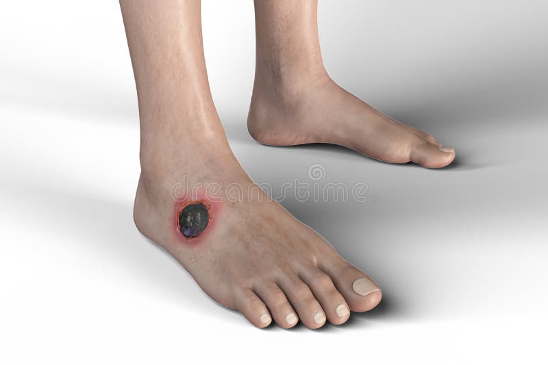 Cutaneous Anthrax, the Most Common Form of Anthrax Stock Illustration ...