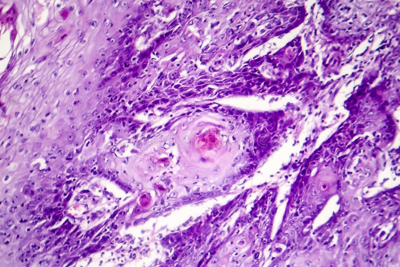 Cutaneous Squamous Cell Carcinoma Stock Image - Image of epithelial ...