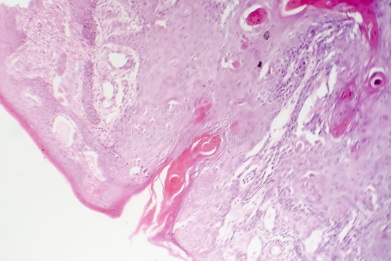 Cutaneous Squamous Cell Carcinoma Stock Image - Image of malignant ...