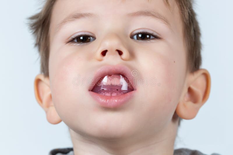 Cute Little Caucasian Boy Shows Myofunctional Trainer. Stock Photo ...