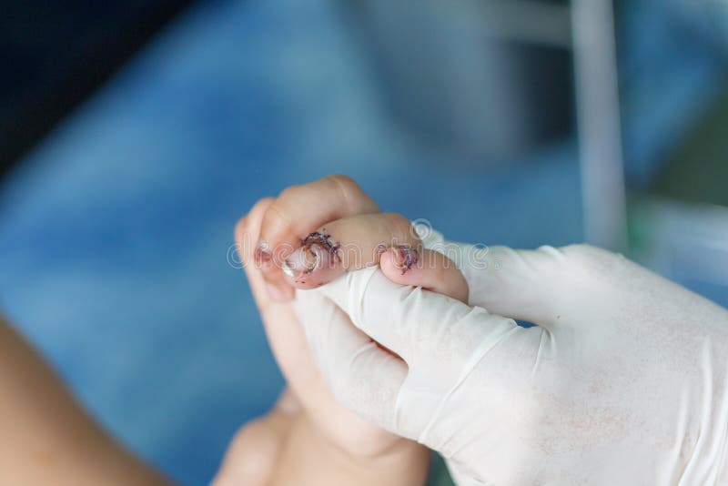 Cutting finger wound stock photo. Image of cure, skill - 163441640