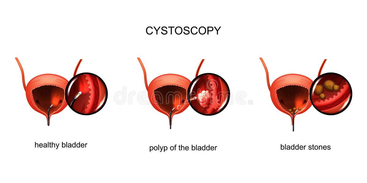 Cystoscopy Stock Illustrations – 199 Cystoscopy Stock Illustrations ...