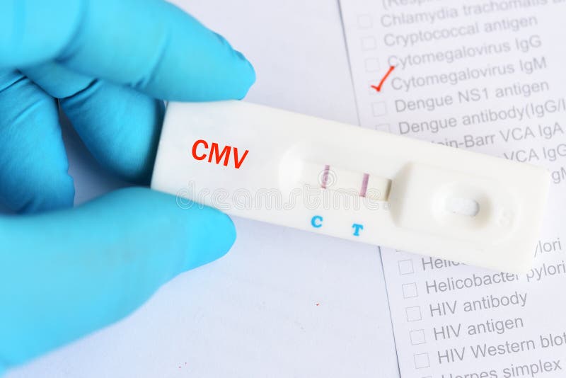 Cytomegalovirus Positive Test Result Stock Photo - Image of herpes ...