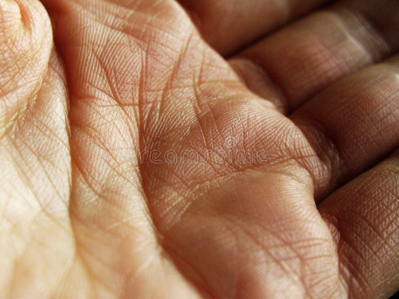 Palmas Con Los Callos Ampollas En Las Manos Heridas Del Trabajo Manual ...