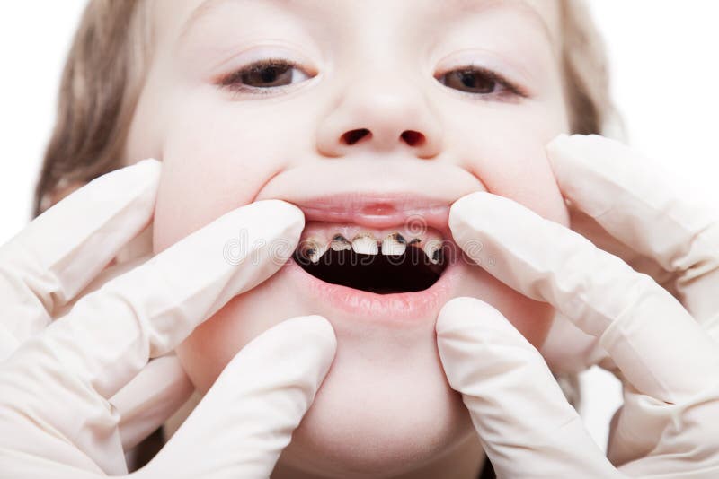 Caries Sur Les Dents De L'enfant Image stock - Image of procédure ...