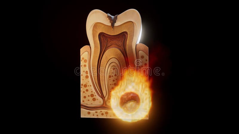 Dental Abscess on Gum Near Tooth with Swelling and Inflammation Dental ...