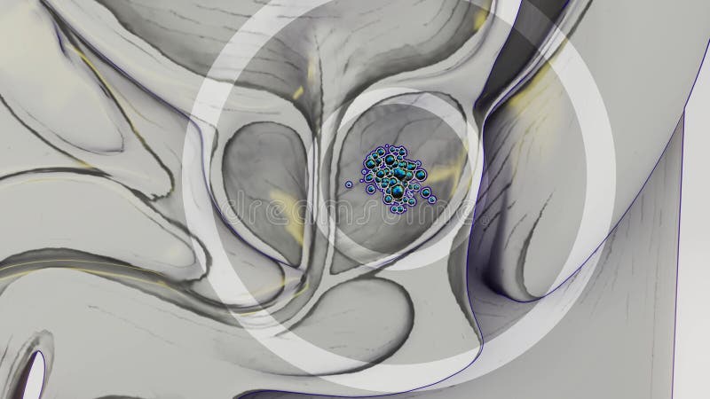 3D Animation of a Prostate Cancer Stock Video - Video of male ...