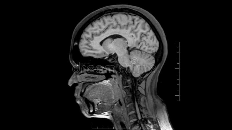 3D Brain View T1W Spir Sequence 12 MRI Scan Stock Video - Video of ...