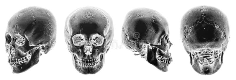 CT Scan Of Human Skull And 3D Stock Photo - Image of neurosurgery ...