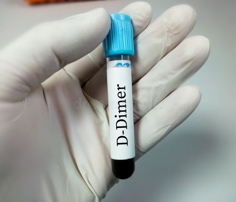 D-Dimer Test. Deep Venous Thrombosis. Disseminated Intra Vascular ...
