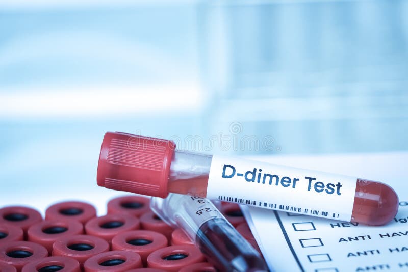 D-dimer Test To Look for Abnormalities from Blood Stock Image - Image ...