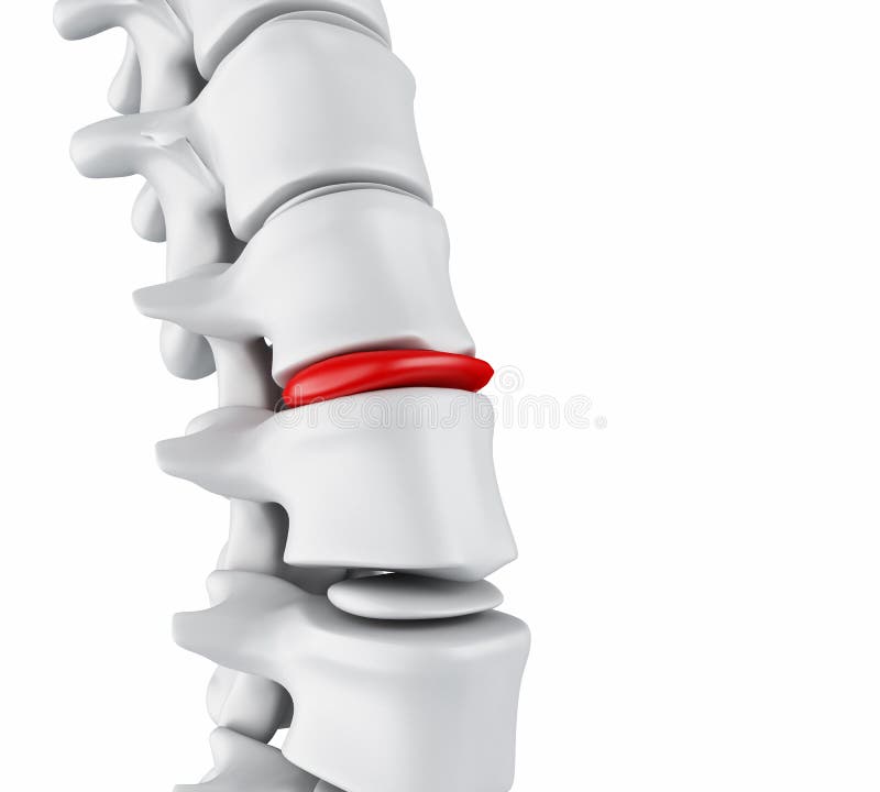3d Herniated disk concept stock illustration. Illustration of pain ...