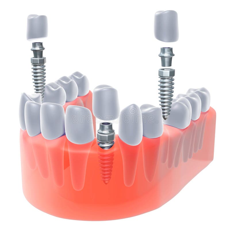3D Illustration of a Double Implant Being Placed in a Gum in a ...
