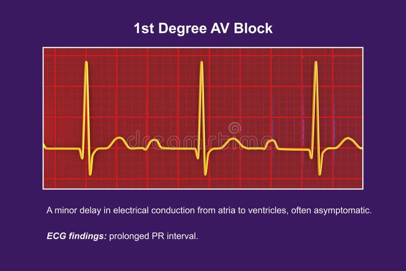 Cardiac Conduction Stock Illustrations – 518 Cardiac Conduction Stock ... Cardiac Conduction Stock Illustrations – 518 Cardiac Conduction Stock ...