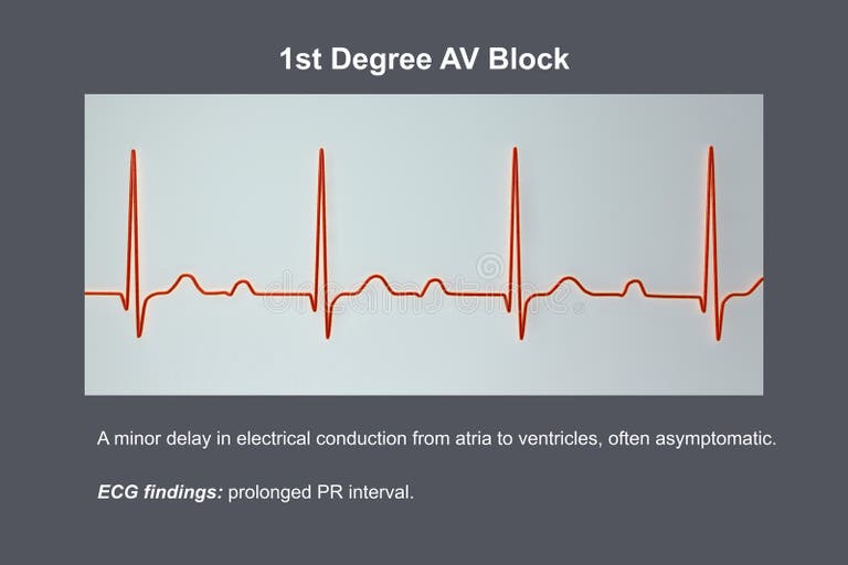 Cardiac Conduction Stock Illustrations – 518 Cardiac Conduction Stock ... Cardiac Conduction Stock Illustrations – 518 Cardiac Conduction Stock ...