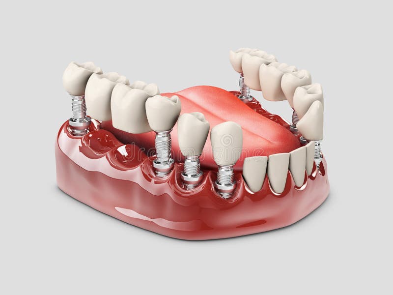 3d Illustration of a Fixed Partial Denture Bridge, Isolated White Stock ...