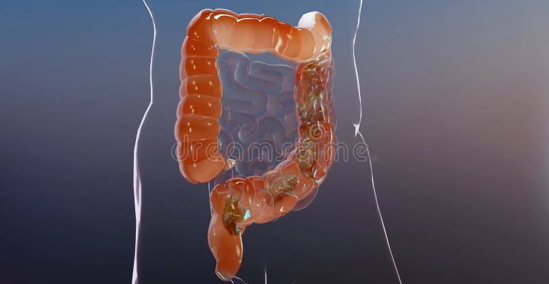 Constipation Anatomy stock illustration. Illustration of chronic ...