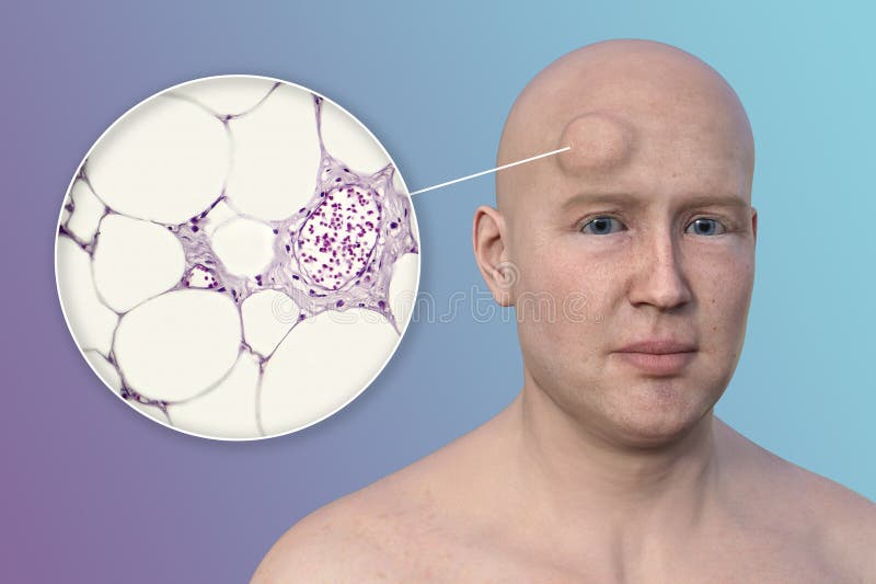 Lipoma on a Man S Forehead, 3D Illustration and Micrograph Stock ...