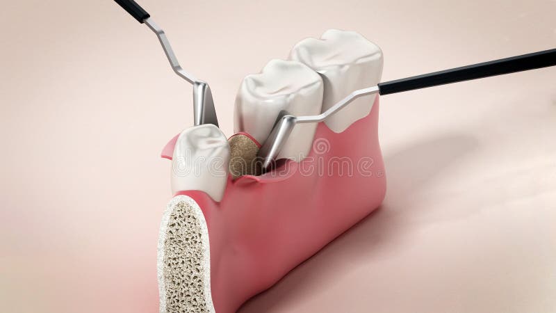 3D Illustration of Mid-crestal Incision Dental Operation. 3D ...