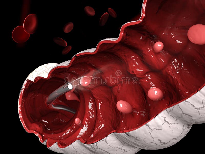 3d Illustration of Removal of a Colonic Polyp with a Electrical Wire ...