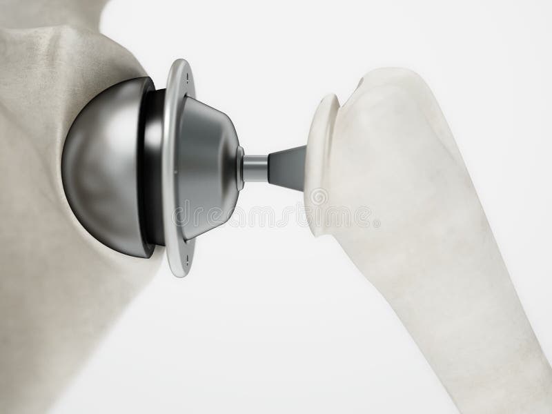 Shoulder Replacement Surgery Stock Illustrations – 69 Shoulder ...