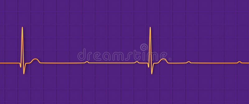 ECG of 3rd Degree AV Block, 3D Illustration Stock Illustration ...