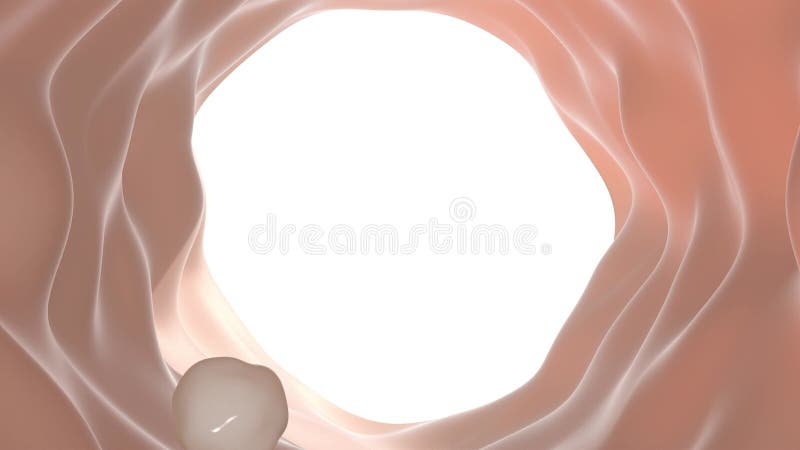 3D Cure of the Gastrointestinal Tract. the Process of Treating the ...