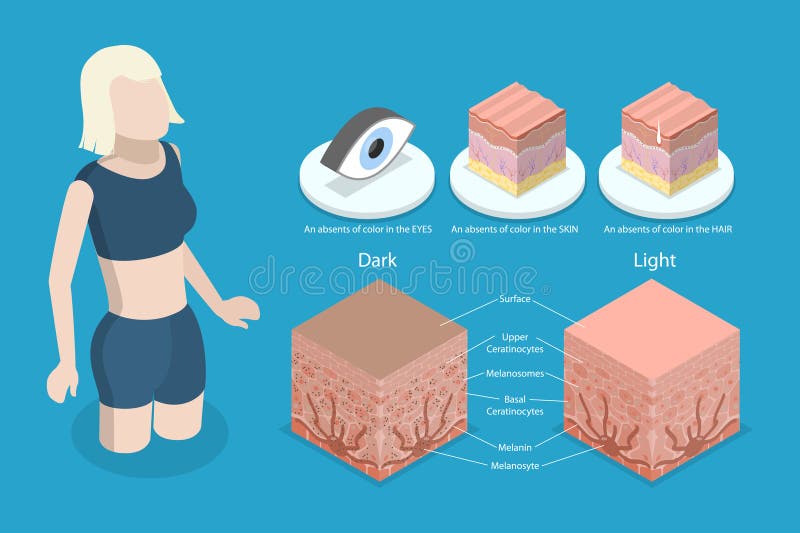 3D Isometric Flat Vector Conceptual Illustration of Albinism Stock ...