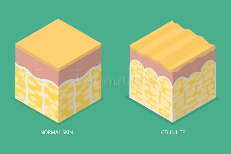 Cellulite Grade Stock Illustrations – 3 Cellulite Grade Stock ...