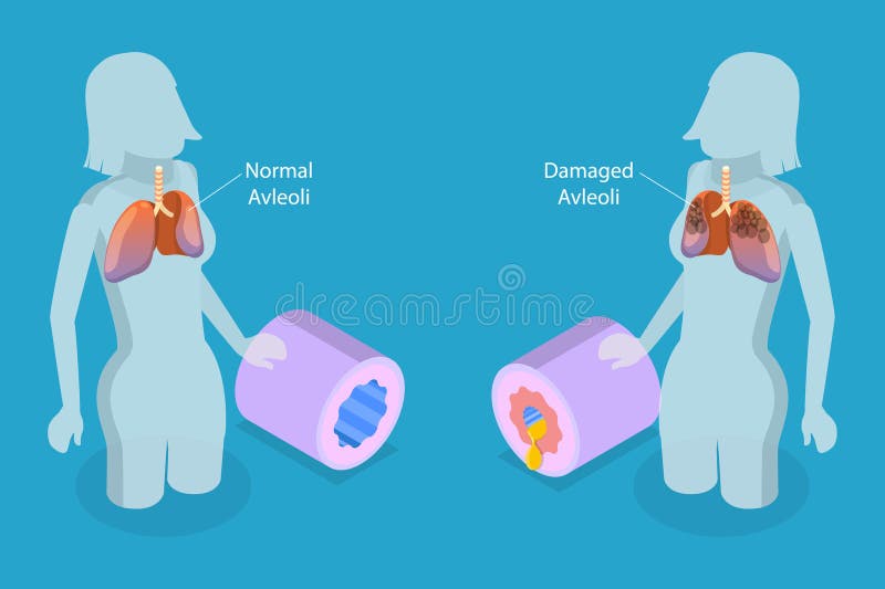 3D Isometric Flat Vector Conceptual Illustration of Chronic Obstructive ...