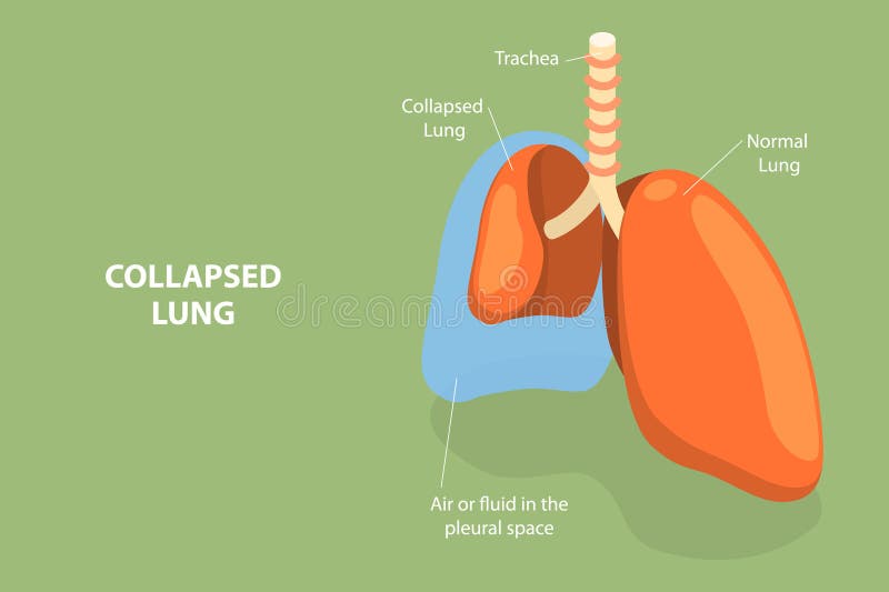 3D Isometric Flat Vector Conceptual Illustration of Collapsed Lung ...