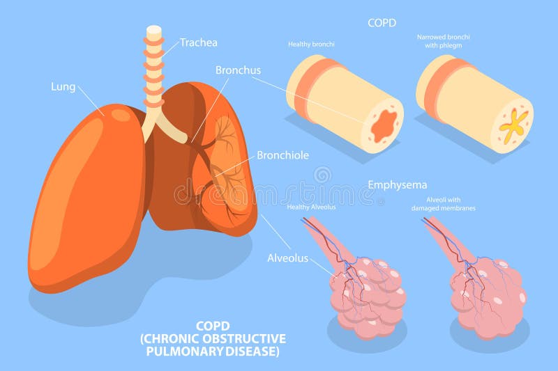 3D Isometric Flat Vector Conceptual Illustration of COPD Stock Vector ...
