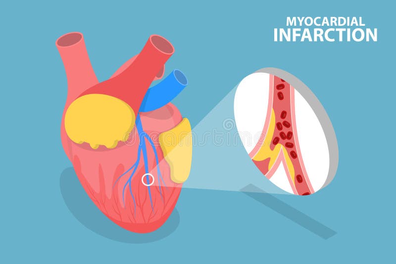 3D Isometric Flat Vector Conceptual Illustration of Myocardial ...