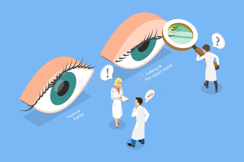 3D Isometric Flat Vector Conceptual Illustration of PTOSIS Stock Vector ...