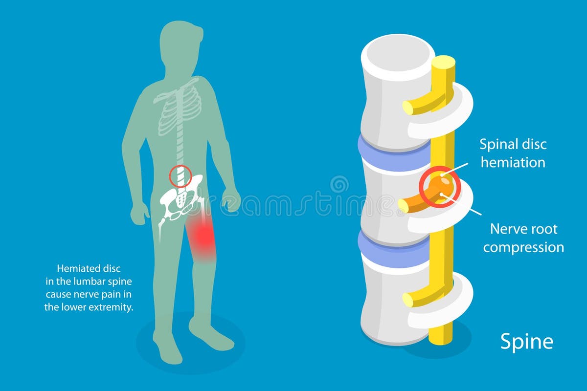 Herniated Disc Cartoon Stock Illustrations – 18 Herniated Disc Cartoon ...