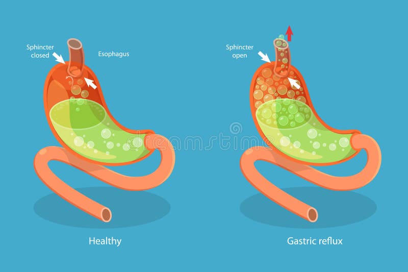 3D Isometric Flat Vector Conceptual Illustration of Stomach Reflux ...