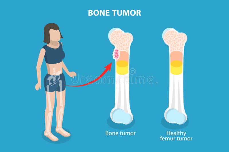 3D Isometric Flat Vector Illustration of Bone Tumor Stock Vector ...