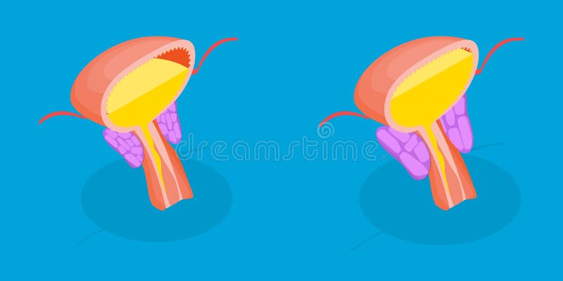 3D Isometric Flat Vector Illustration of Enlarged Prostate Gland Stock ...