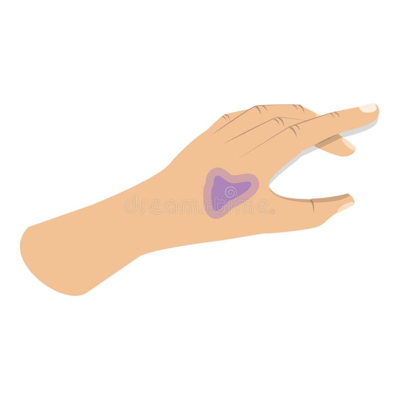 3D Isometric Flat Vector Illustration of First Aid for Trauma. Item 6 ...