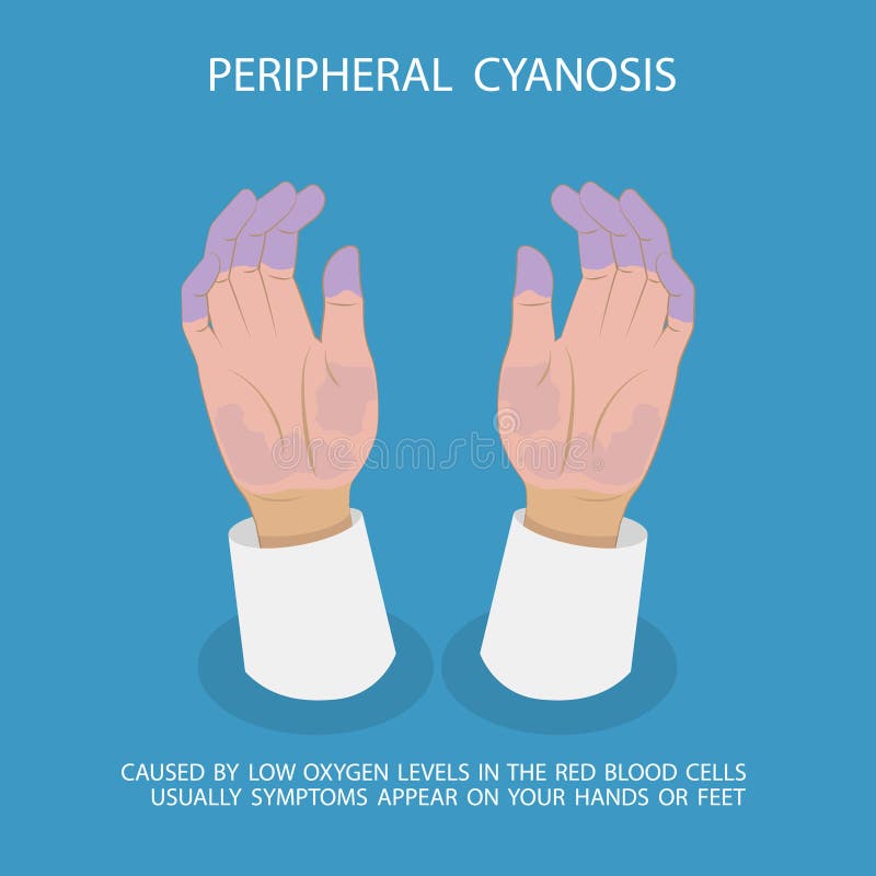 Cyanosis Symptoms Stock Illustrations – 15 Cyanosis Symptoms Stock ...