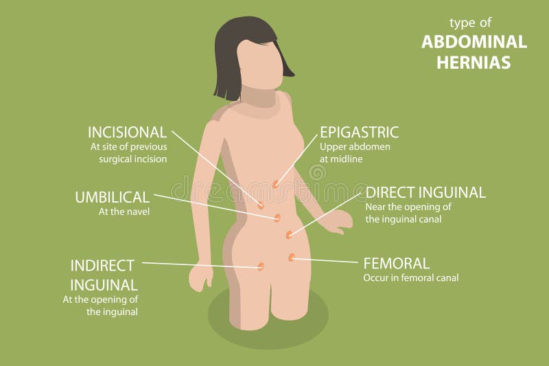 3D Isometric Flat Vector Illustration of Type of Abdominal Hernias ... 3D Isometric Flat Vector Illustration of Type of Abdominal Hernias ...