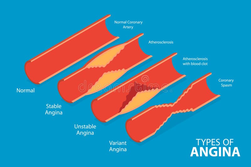 3D Isometric Flat Vector Illustration of Types of Angina Stock Vector ...