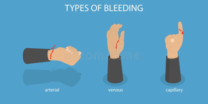 3D Isometric Flat Vector Illustration of Types of Bleeding Stock Vector ...