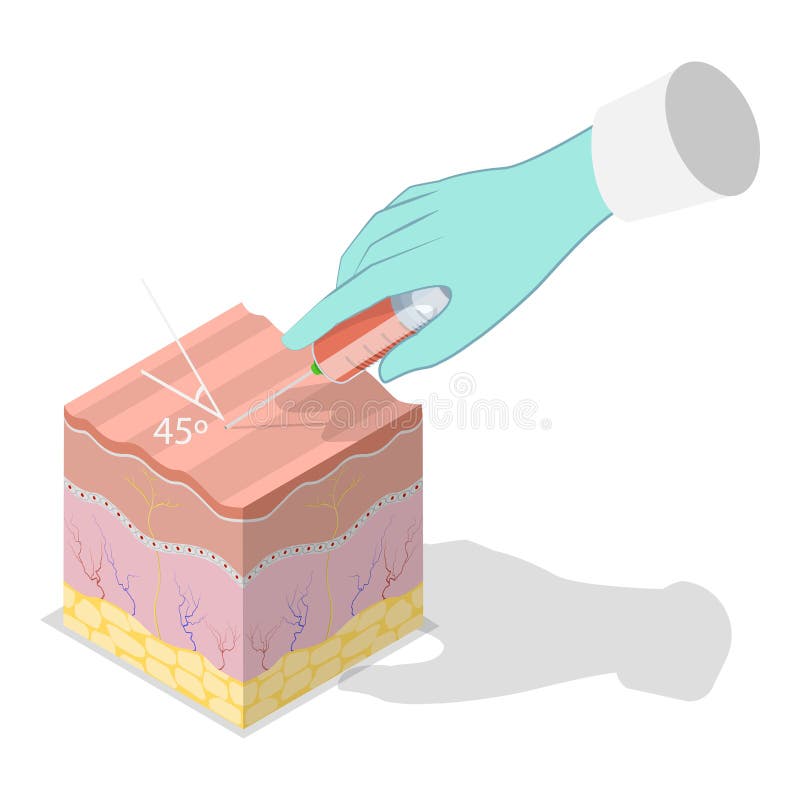 Subcutaneous Injections Stock Illustrations – 42 Subcutaneous ...