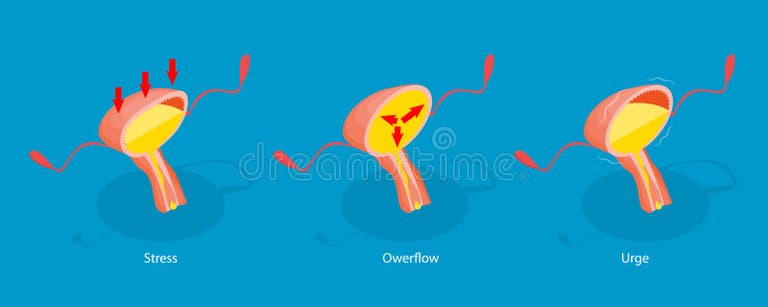 Stress Urinary Incontinence Stock Illustrations – 81 Stress Urinary ...