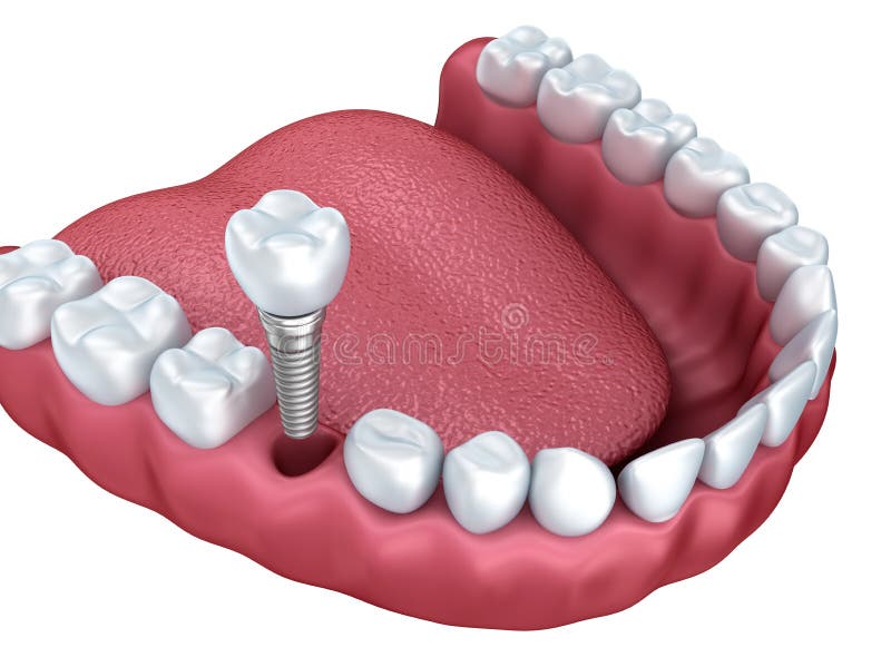 3d Lower Teeth and Dental Implant Isolated Stock Illustration ...
