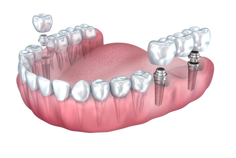 3d Lower Teeth and Dental Implant Isolated Stock Illustration ...