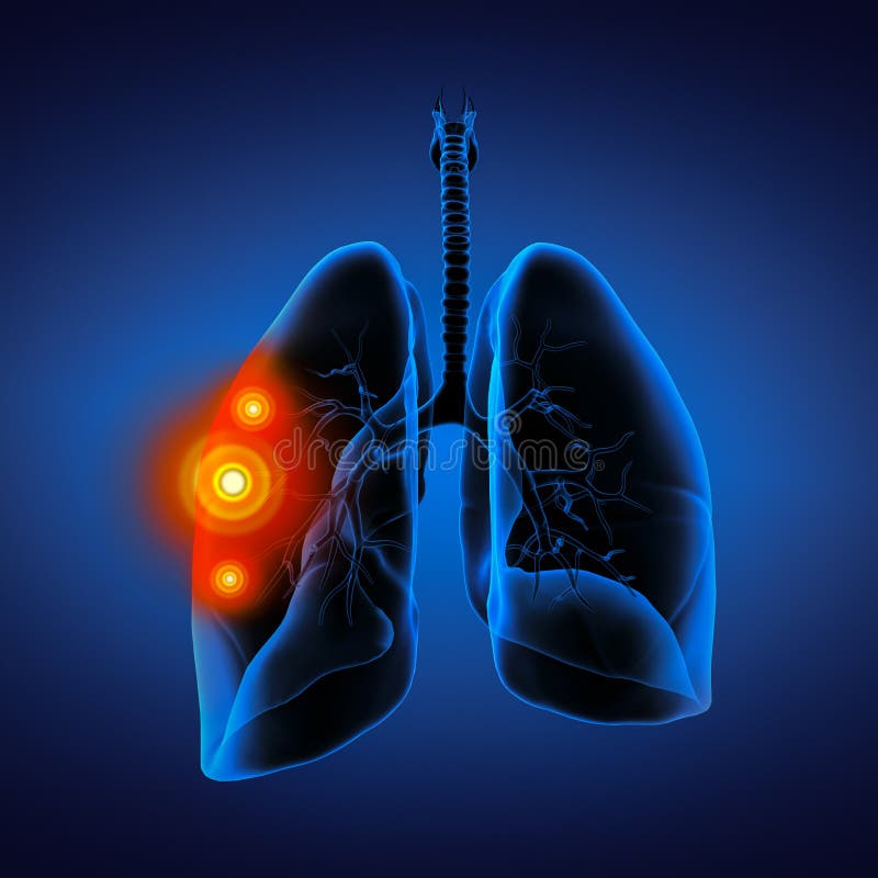 3D Rendering Illustration of Lung Stock Illustration - Illustration of ...