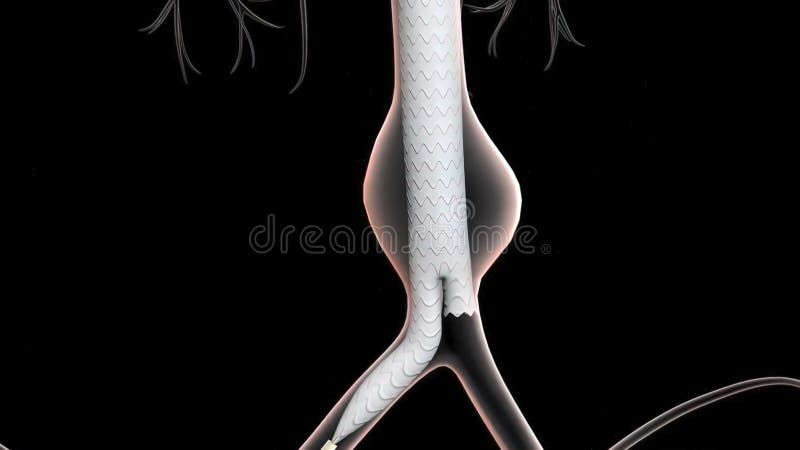 3D Medical Illustration of Pulsatile Abdominal Aortic Aneurysm Stock ...