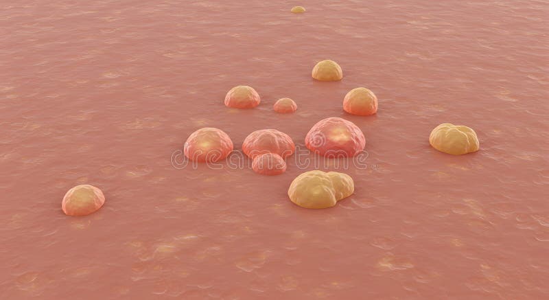 Microscopic 3D Render of Skin Lesions: Detailed Visualization of ...